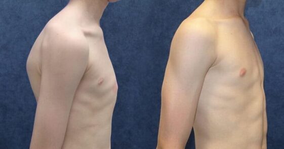 How common is pectus Carinatum?