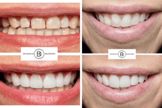 How much do veneers cost?