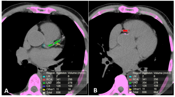 What is an SCA score?