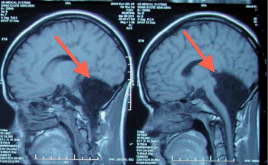 Will an MRI show fluid on the brain?