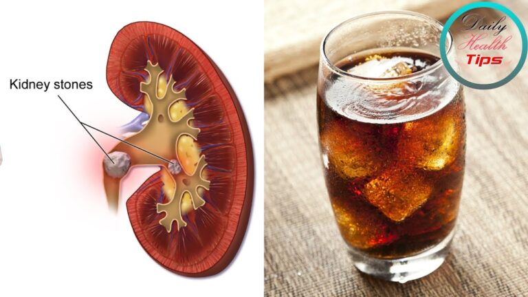 Can soda cause kidney stones?